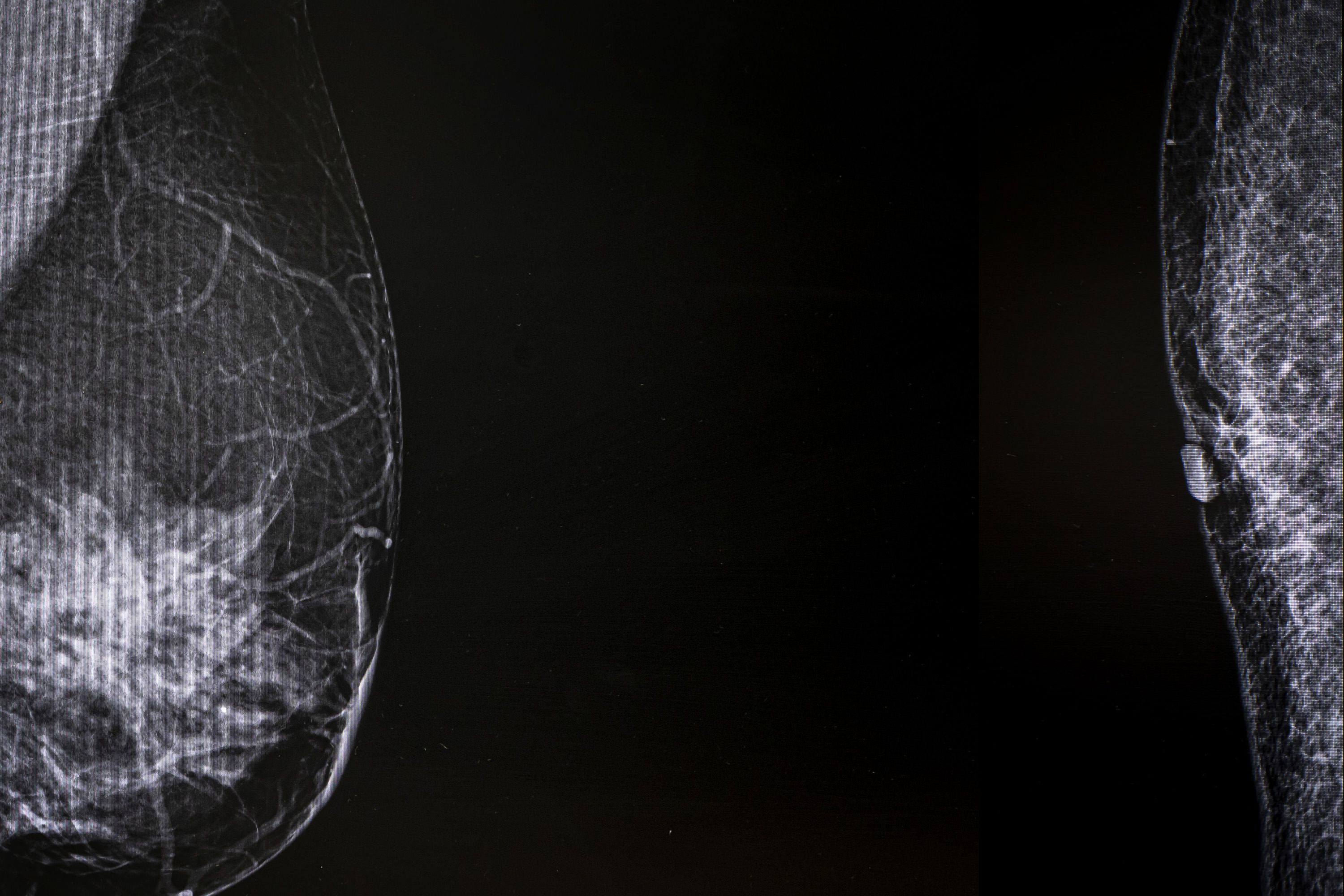 Cáncer de mama a oscuras: los hombres también tienen pechos